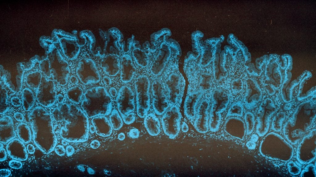 Adenomatous polyps: Causes, risk factors, and treatment