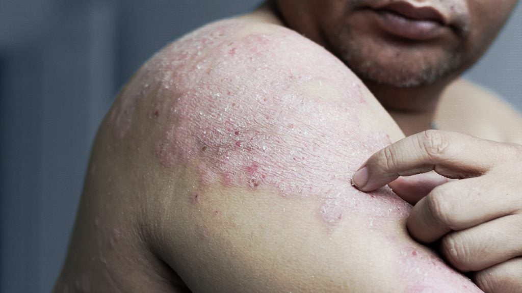 Psoriasis itch relief: Treatments and home remedies