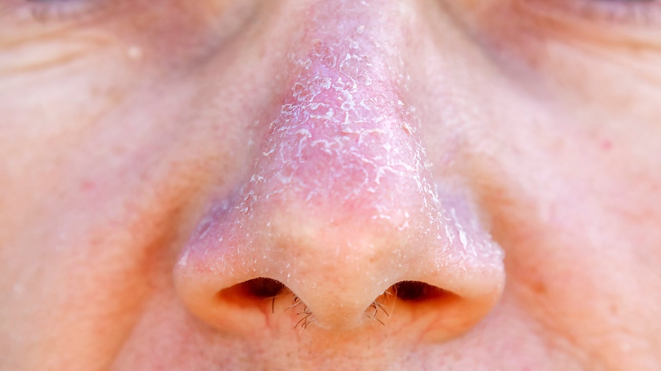 Cellulitis Nostril Cellulitis Nostril