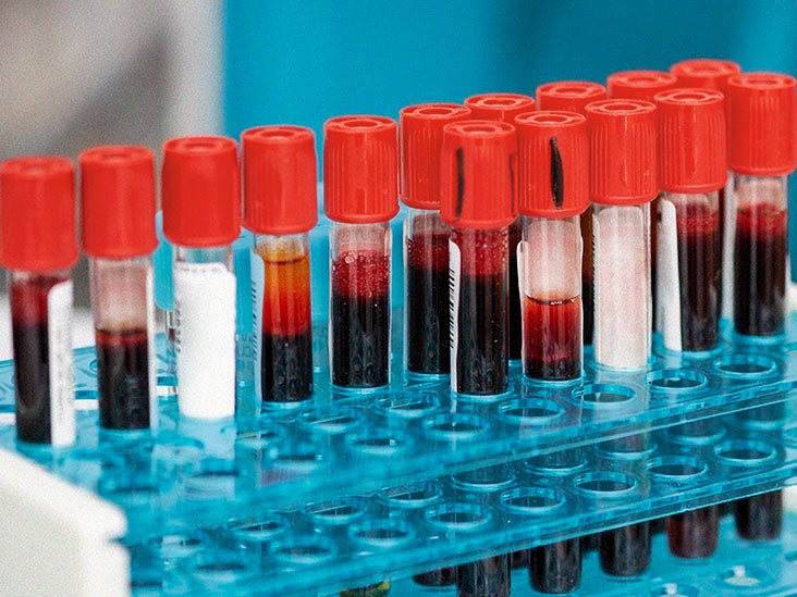 Smoldering multiple myeloma: What it is, symptoms, and more