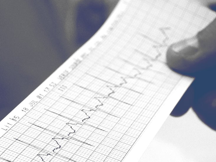 What is ventricular tachycardia? Types, symptoms, treatment