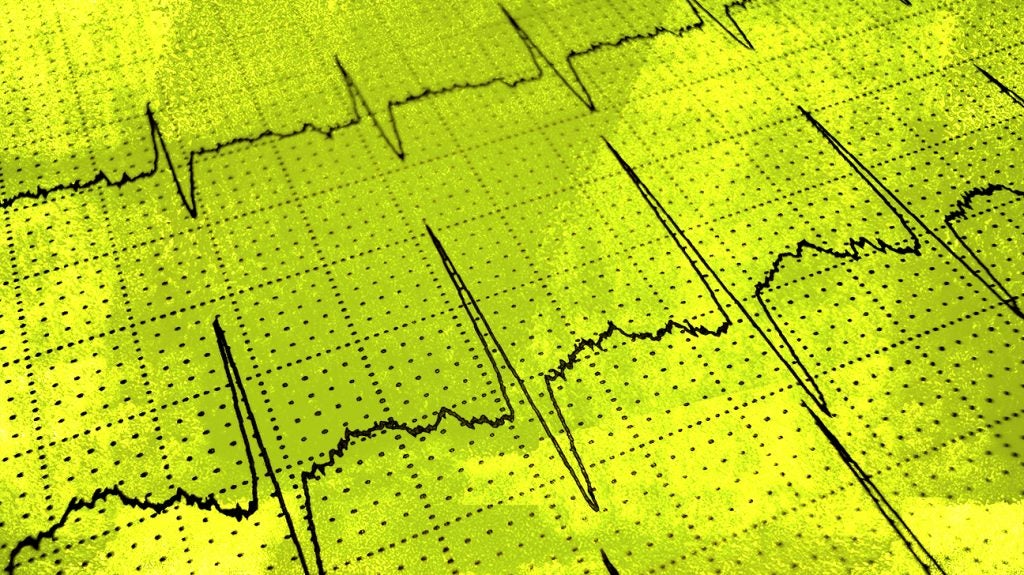 Atrial fibrillation: What are the different types?