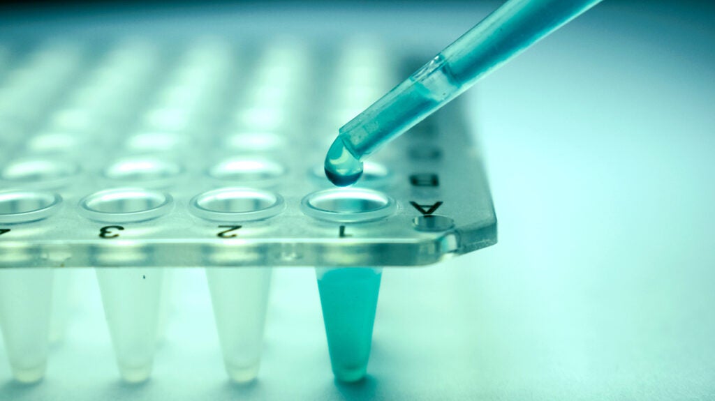 Leukemia stem cell transplant: Can it cure leukemia, and how?