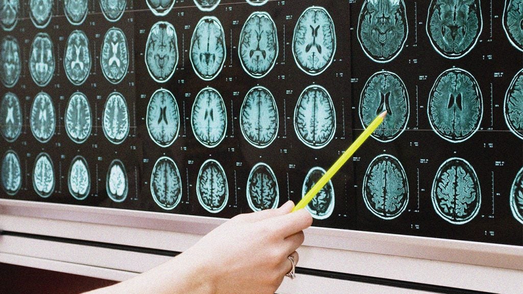 Brain Metastases Symptoms Prognosis Diagnosis And More