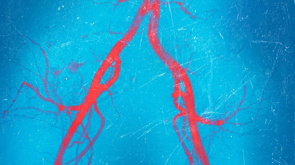 Coronary artery spasm: Definition, symptoms, and causes