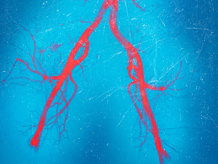 Coronary artery spasm: Definition, symptoms, and causes