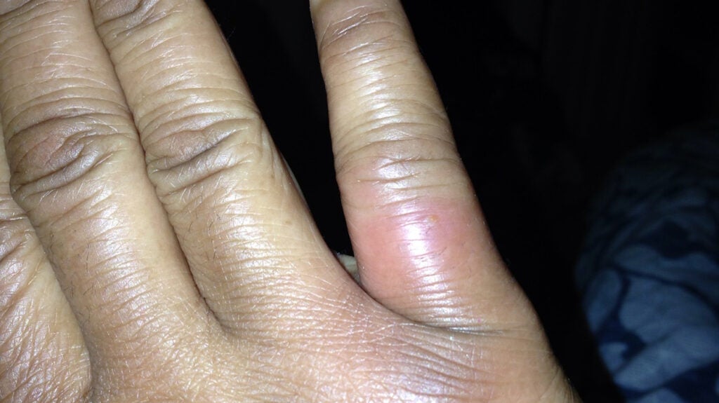 What Do Harmless Spider Bites Look Like