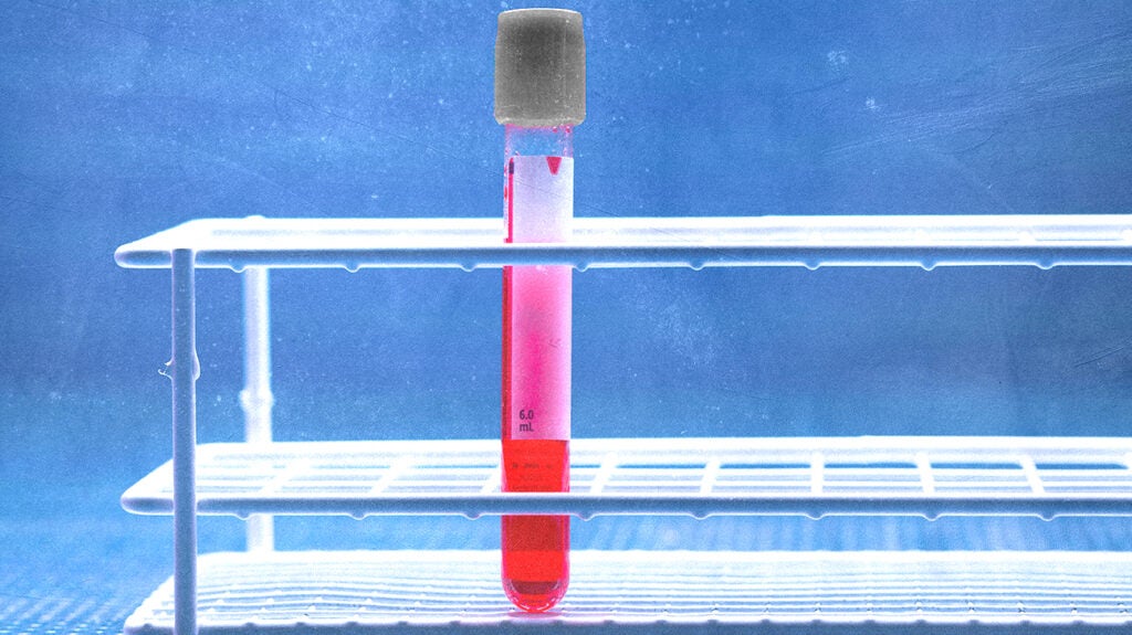 CLL flow cytometry: How it works, diagnosis, and more