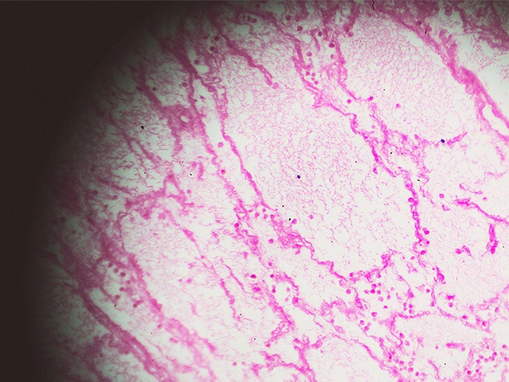 What is the difference between MGUS and multiple myeloma?