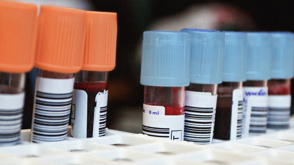 Chronic lymphocytic leukemia: Lymphocyte counts and ranges