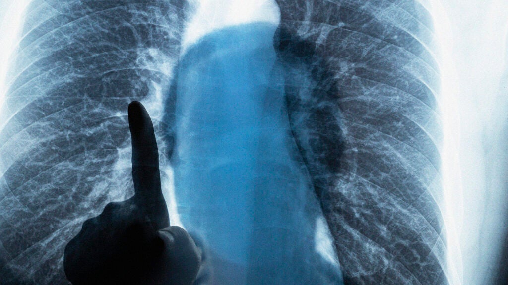 COPD and lung transplants: Benefits, eligibility, and life expectancy
