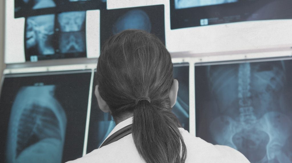 Sacroiliitis: Causes, symptoms, and treatment