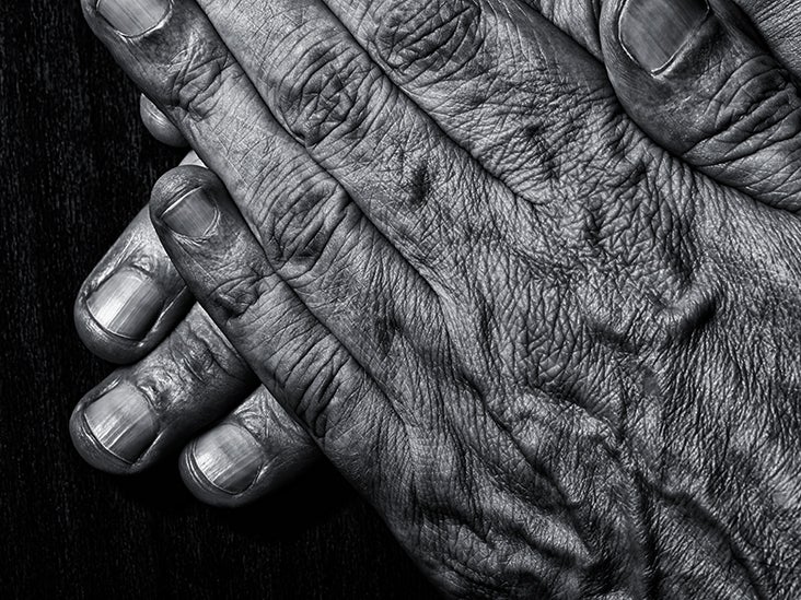Wrinkles on black skin: Causes, treatment, and prevention