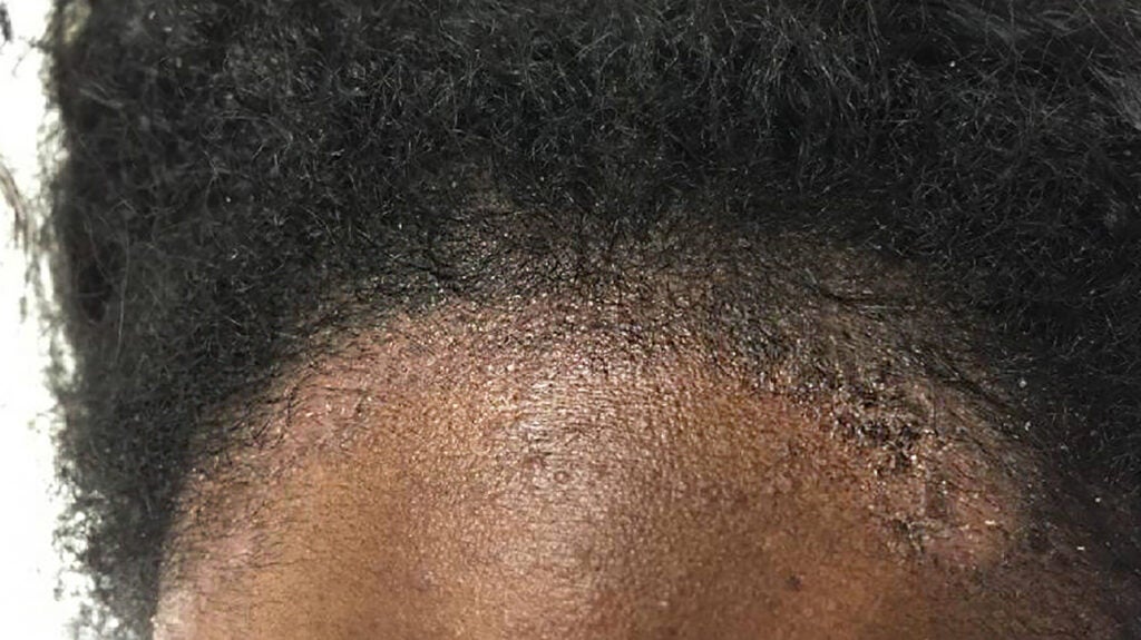 Psoriasis Signs, Symptoms, and Early Stages