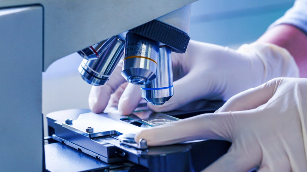 Poorly differentiated small-cell lung cancer: What to know