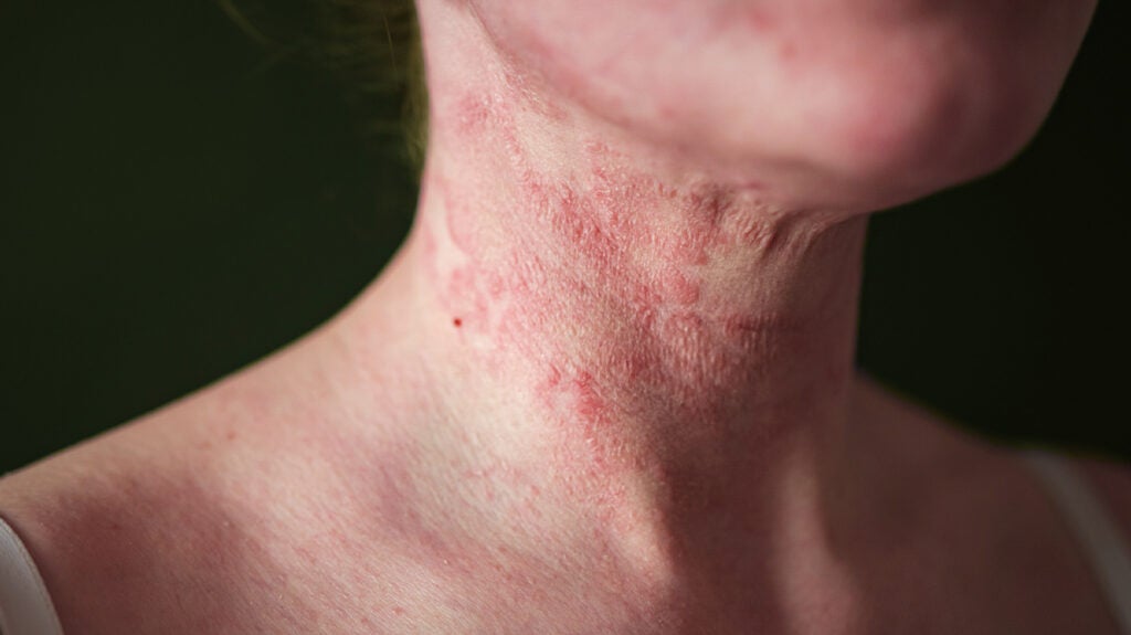 What is the difference between atopic dermatitis and eczema?