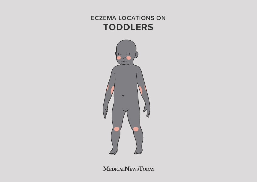Toddler eczema: Signs, development, triggers, and more