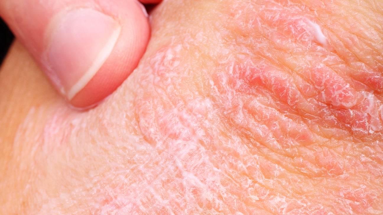 Eczema Bumps On Elbows Eczema Bumps On Elbows