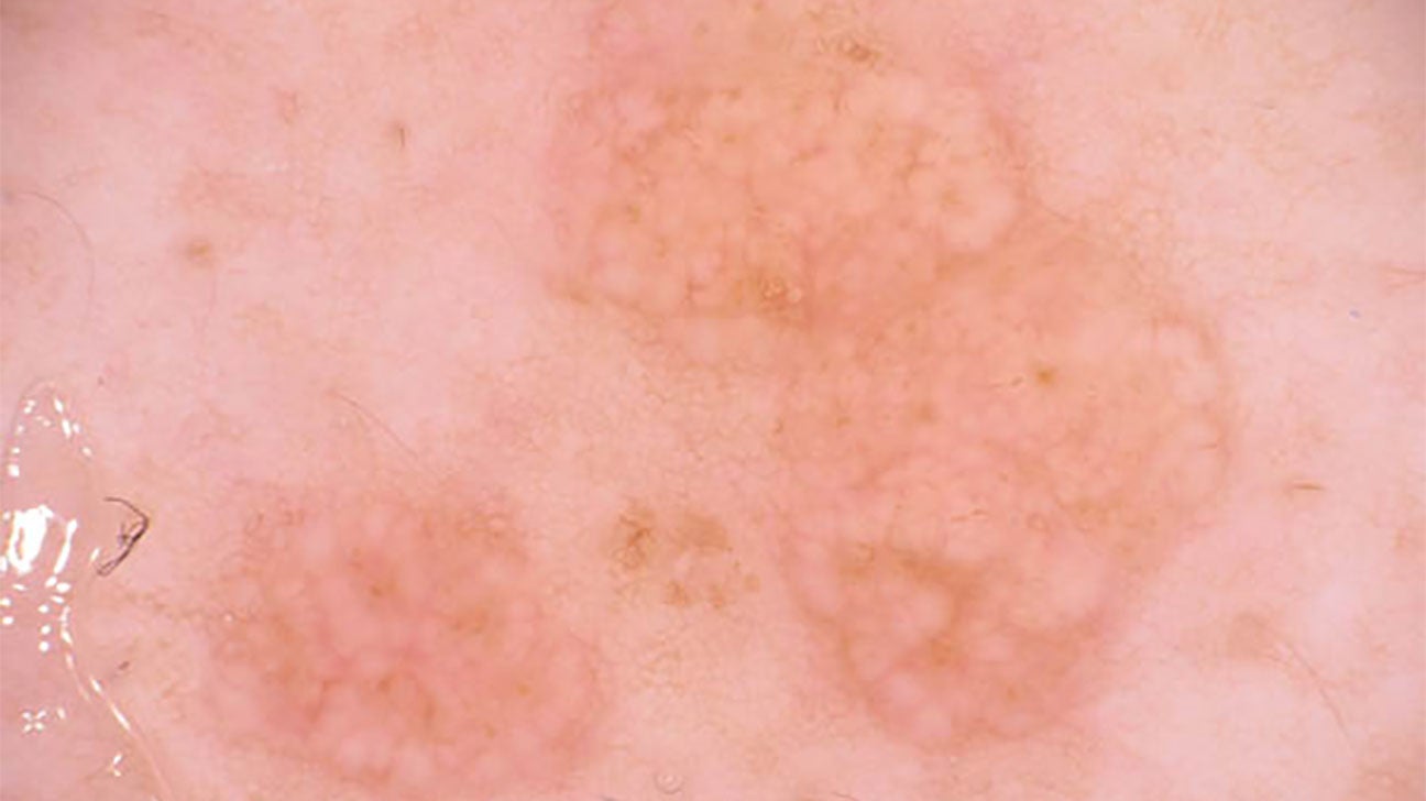 Sebaceous hyperplasia: Definition and treatment options