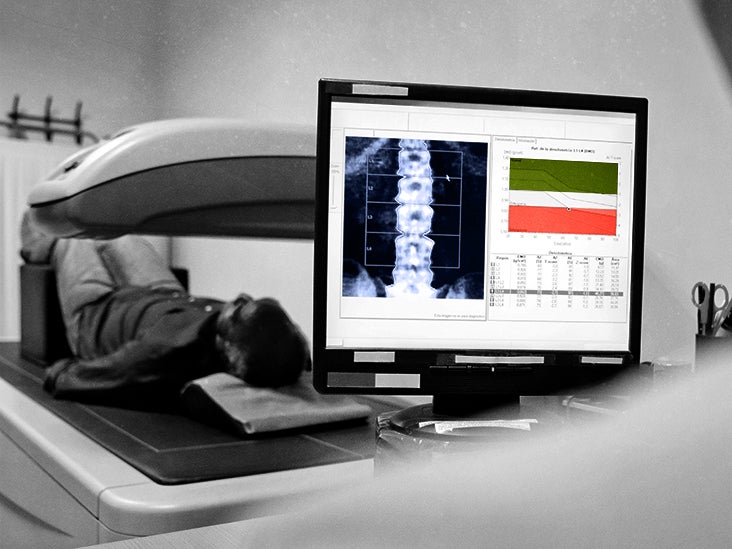 Does a bone density test show arthritis?
