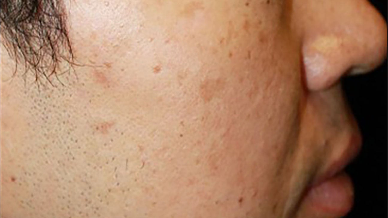 Sebaceous hyperplasia: Definition and treatment options