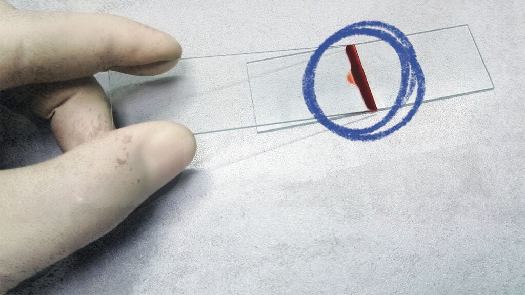 Testing for leukemia: What are your options?