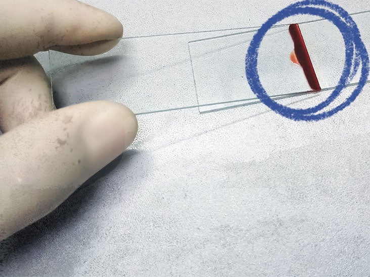 Testing for leukemia: What are your options?