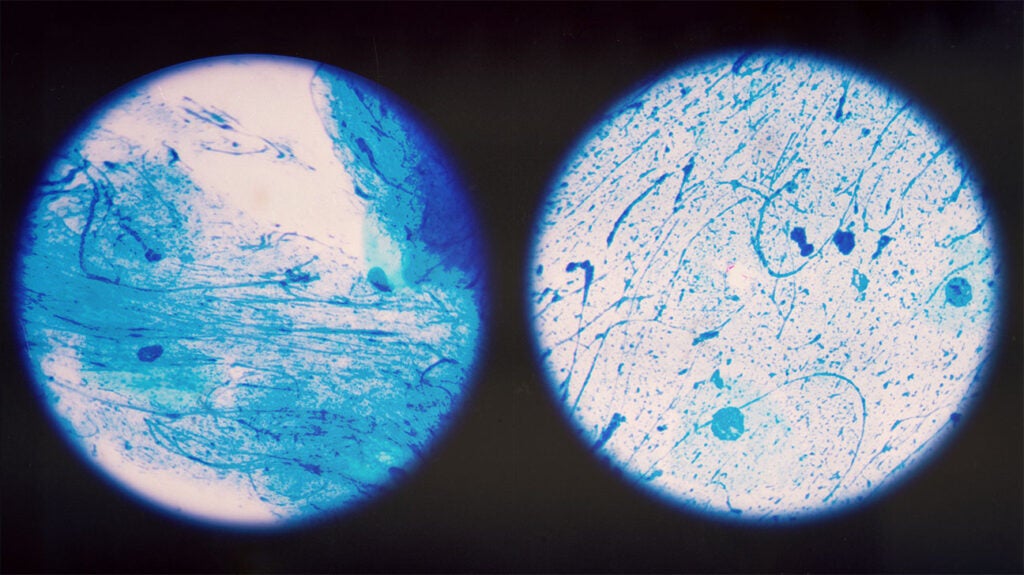 How does a TB blood test work and who should get it?