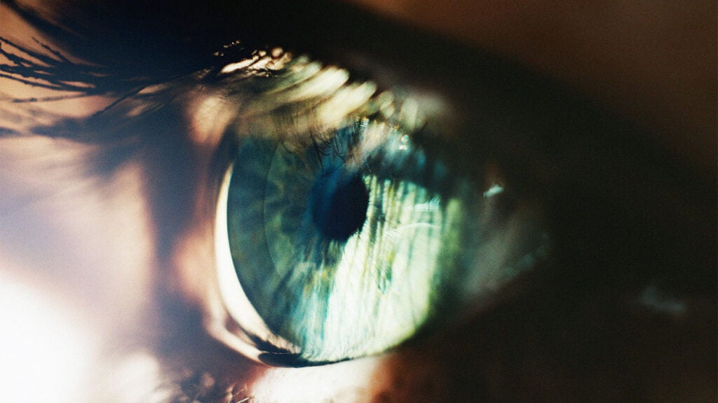 Atopic keratoconjunctivitis: Symptoms, causes, treatment