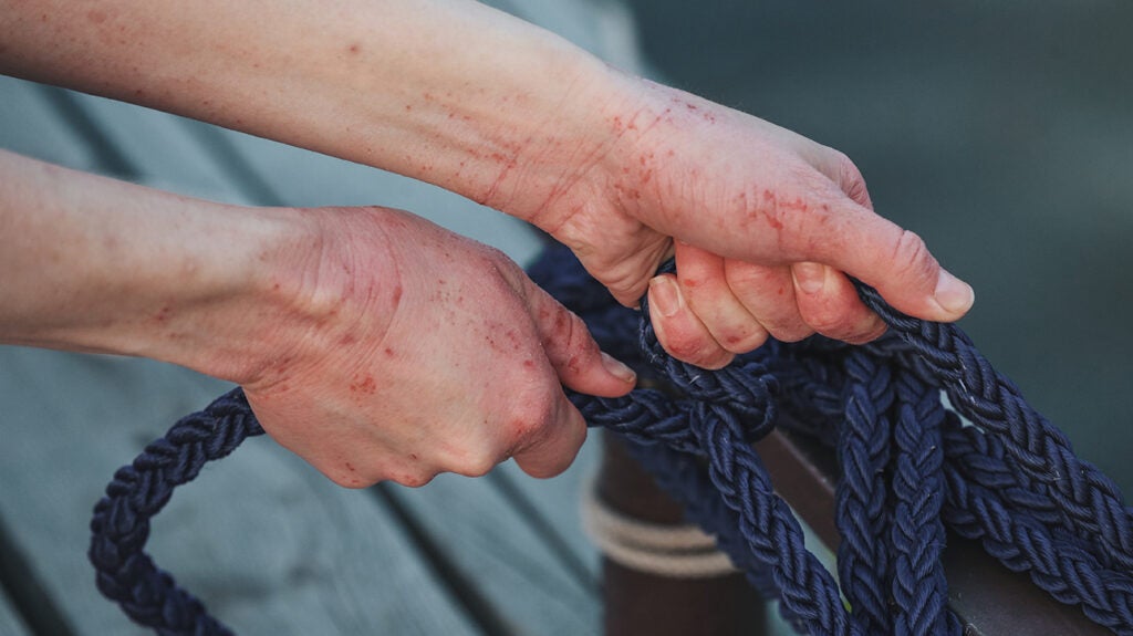 Is eczema an autoimmune disease? What to know