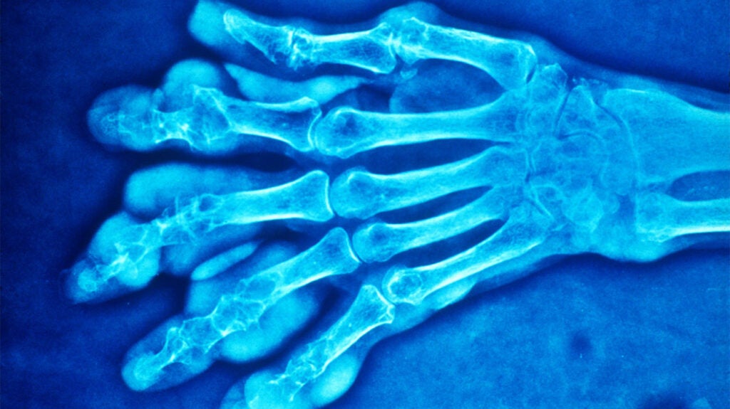 Can a person get gout in their hands?