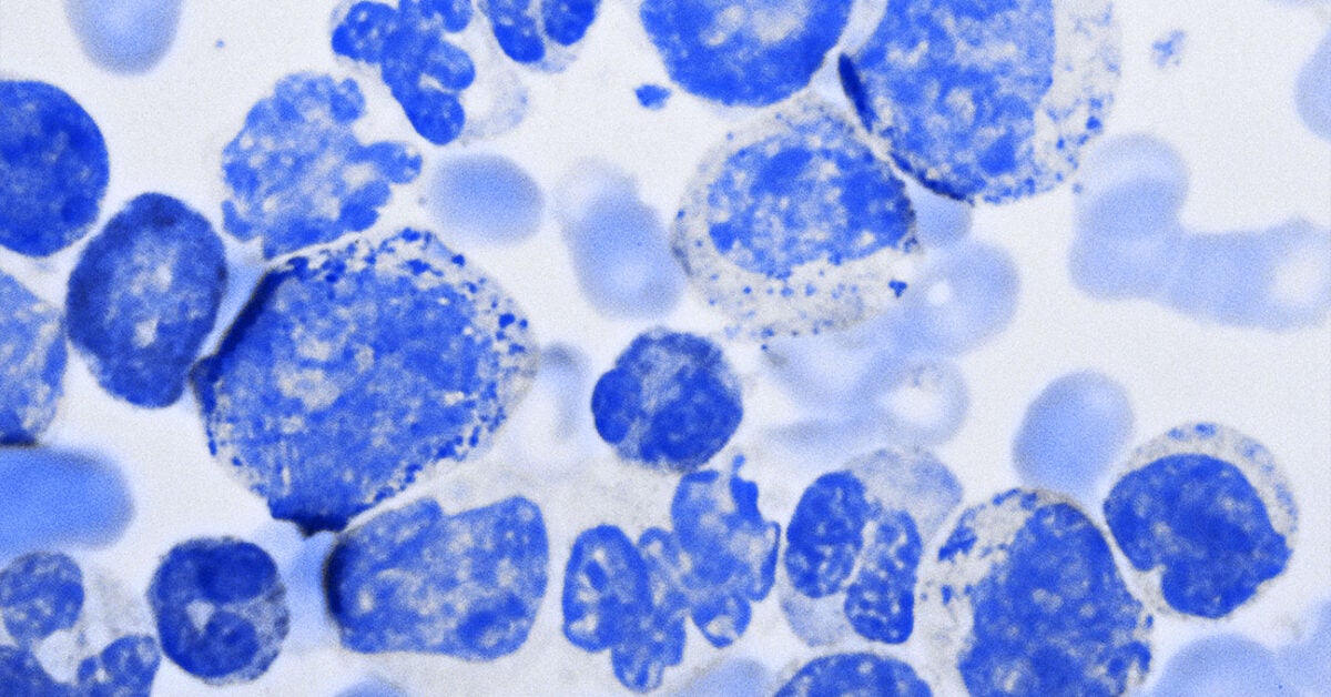 Leukemoid reaction vs. CML: What to know