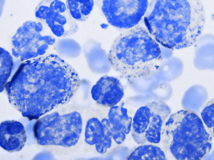 Leukemia Cells Differential