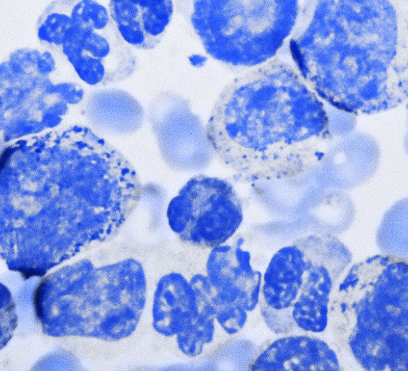 Leukemoid reaction vs. CML: What to know