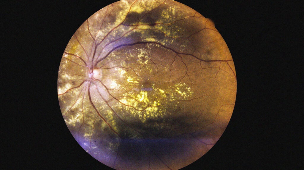 Dry age-related macular degeneration (AMD)