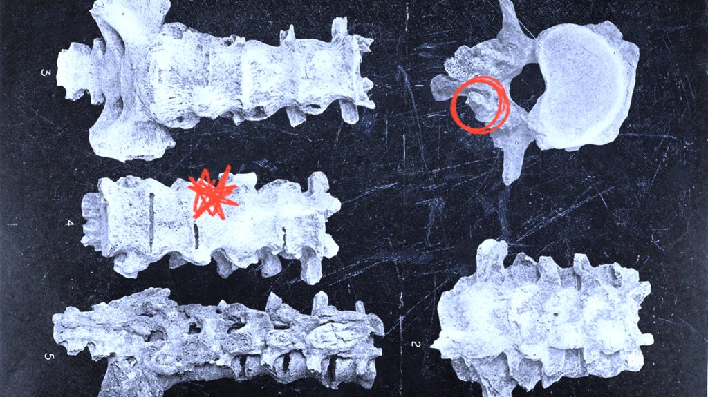 Spondylitis: Types, symptoms, diagnosis, and treatment