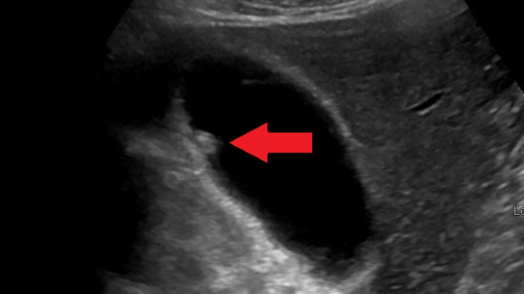 Gallbladder polyps: Symptoms, causes, and treatments