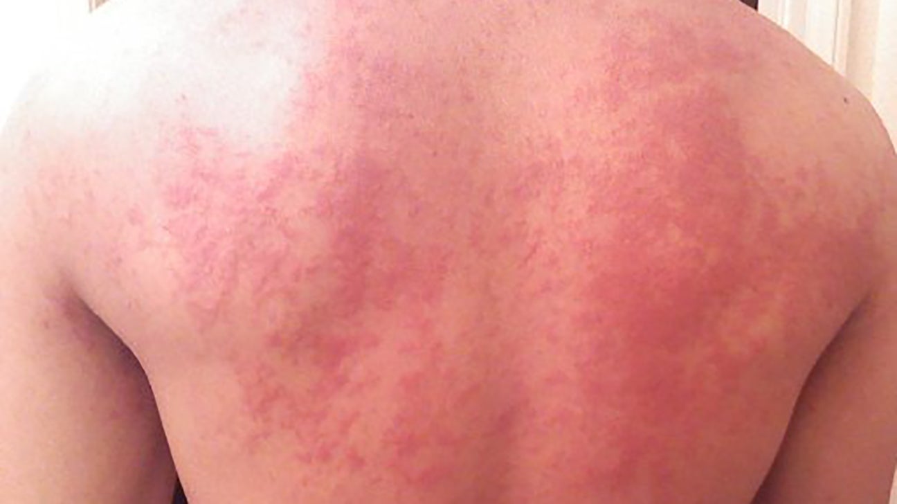 Angioedema Every Day