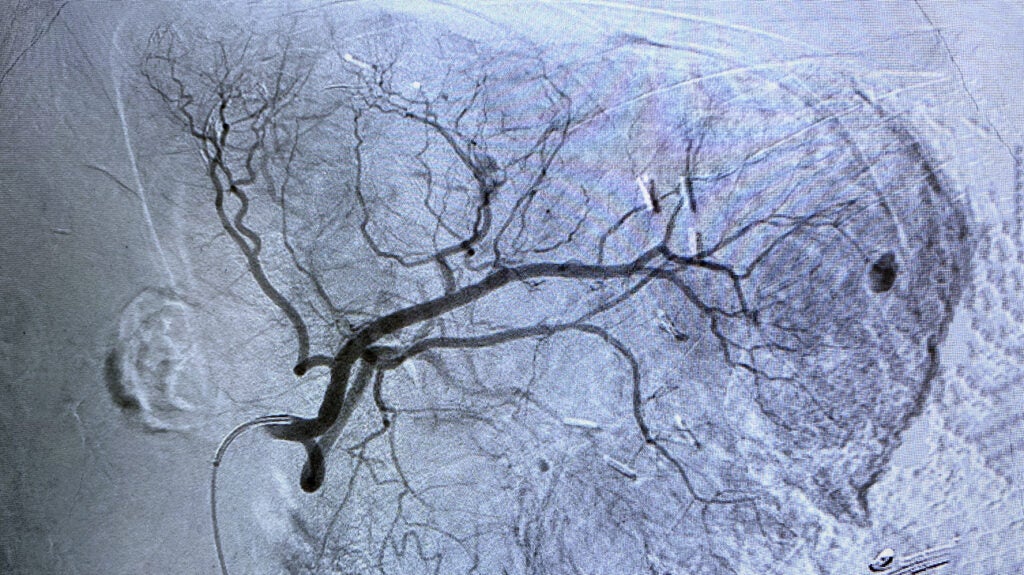NAFL, NAFLD, and NASH: Similarities and differences