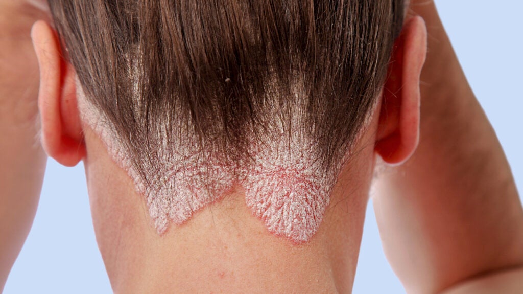 Scalp Psoriasis vs Dandruff: Symptoms, Pictures, and causes