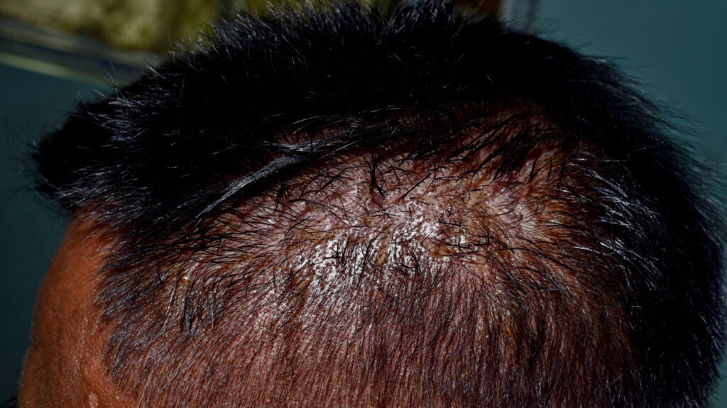 Scalp Psoriasis vs Dandruff: Symptoms, Pictures, and causes