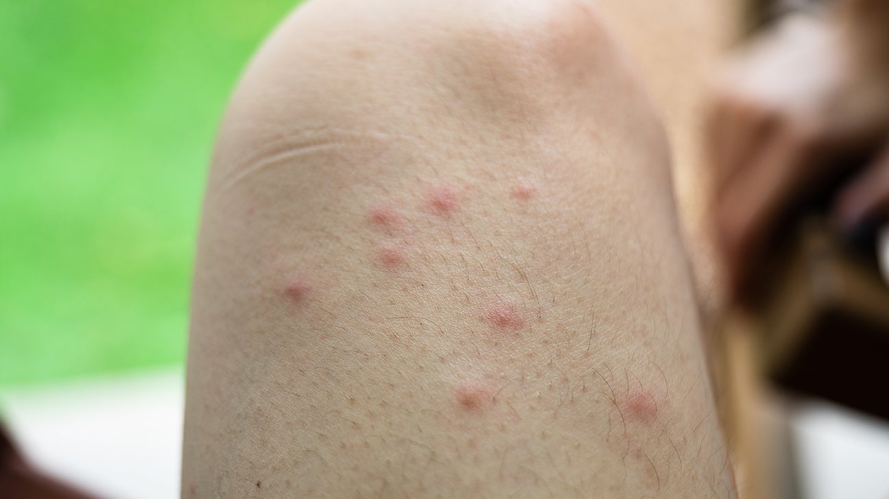What Bit Me How To Identify Common Bug Bites 53 OFF What Bit Me How To Identify Common Bug Bites 53 OFF
