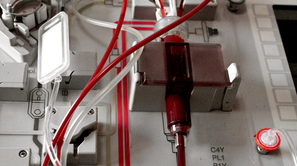 Multiple myeloma: Autologous stem cell transplants explained