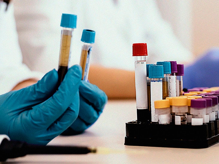 Platelet count blood test: What are high, low, and normal values