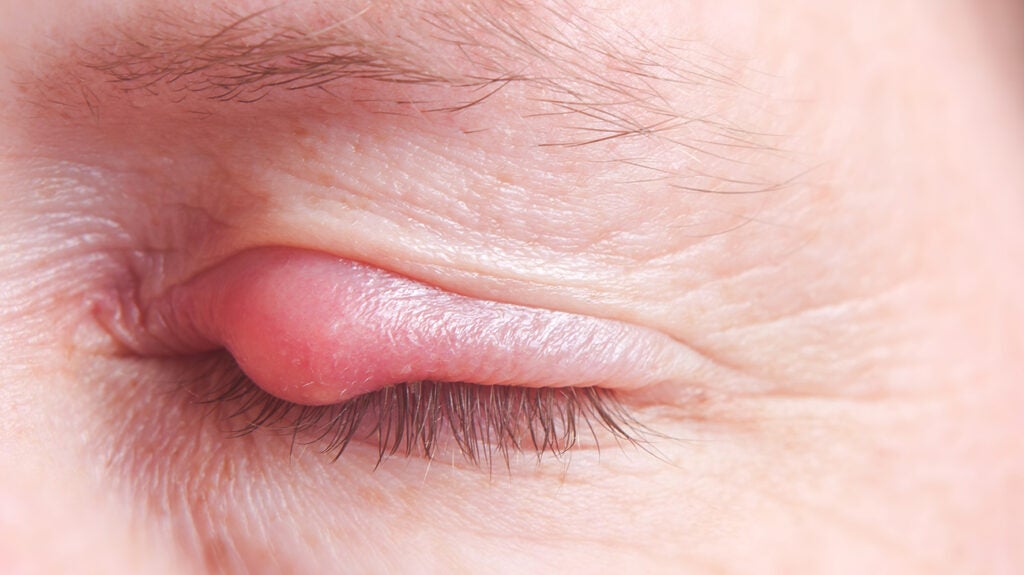 Stye inside eyelid (internal stye): How to identify, and treatments