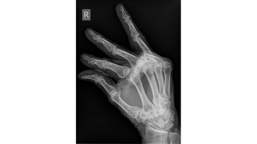 Dupuytren's contracture: Treatment, causes, and more