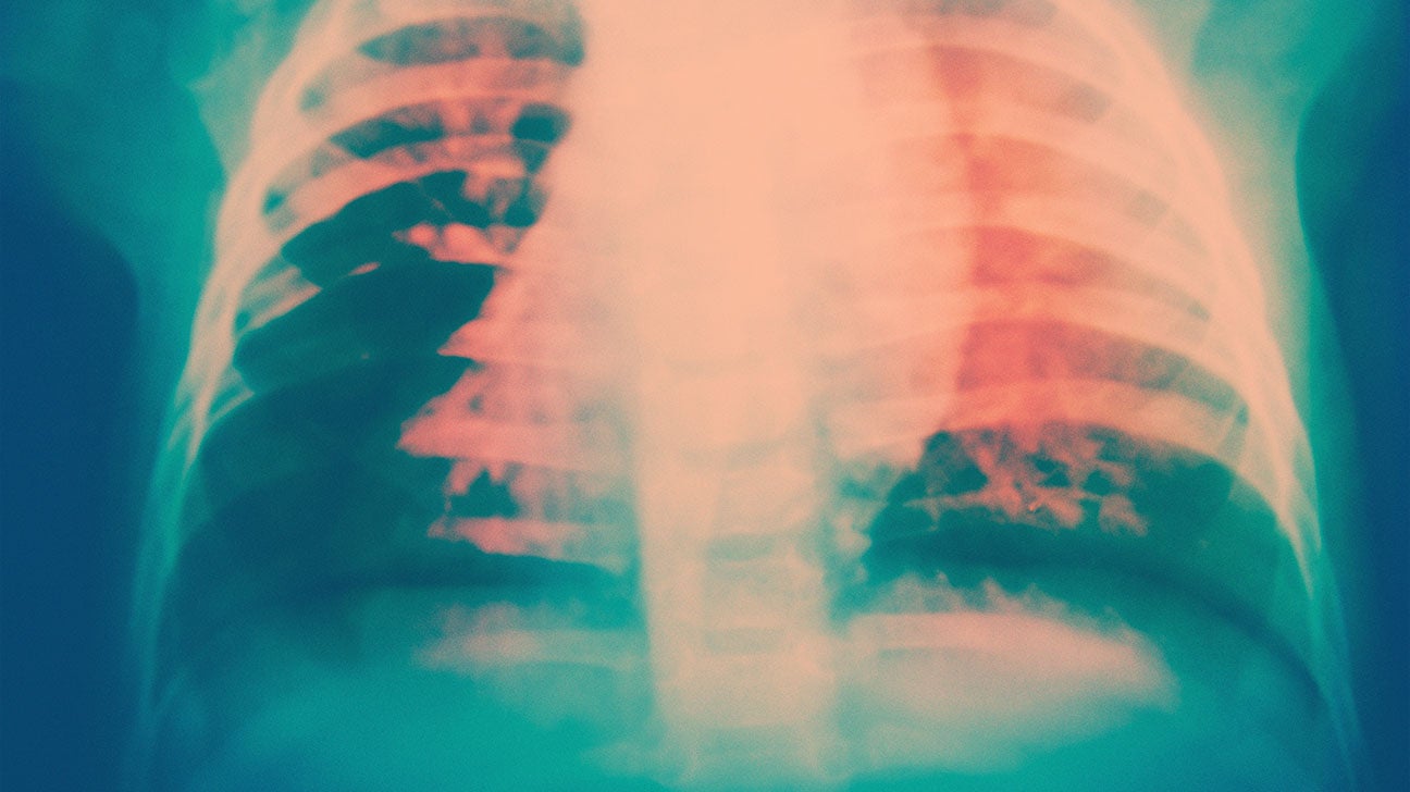 Diagnóstico de hipertensión pulmonar, qué esperar