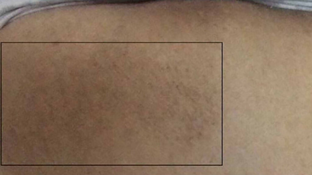 Notalgia paresthetica: Treatment, exercises, causes, and symptoms