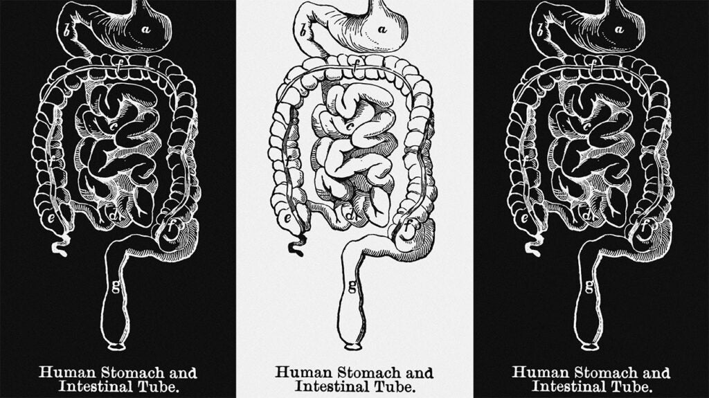 Bowel obstruction: Symptoms, causes, treatment, and diet