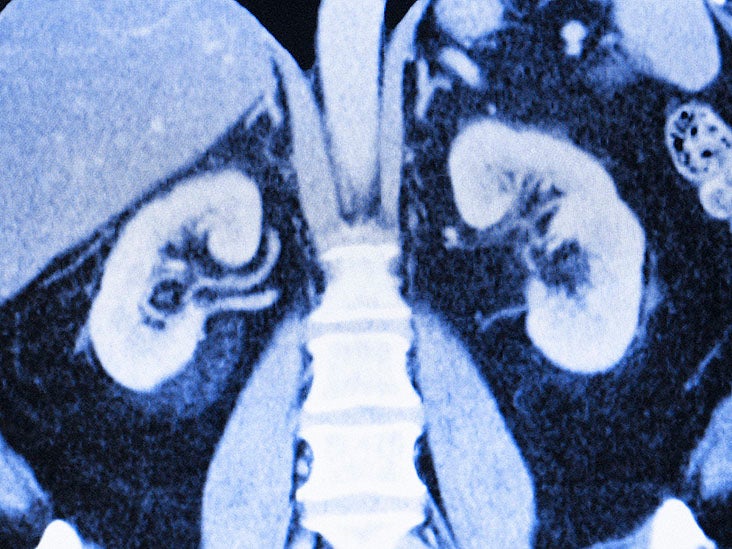Types of kidney cancers: Symptoms, treatment, and outlook